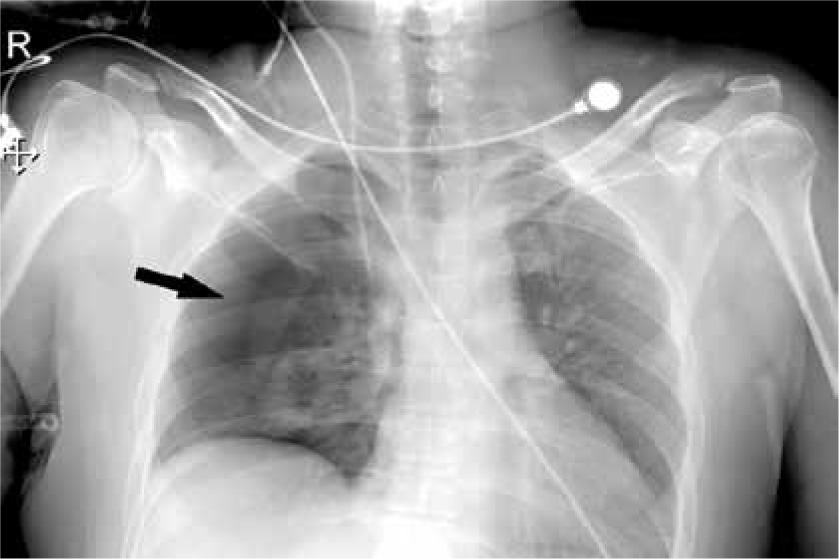 Barotrauma in critically ill COVID-19 patients: a retrospective case ...