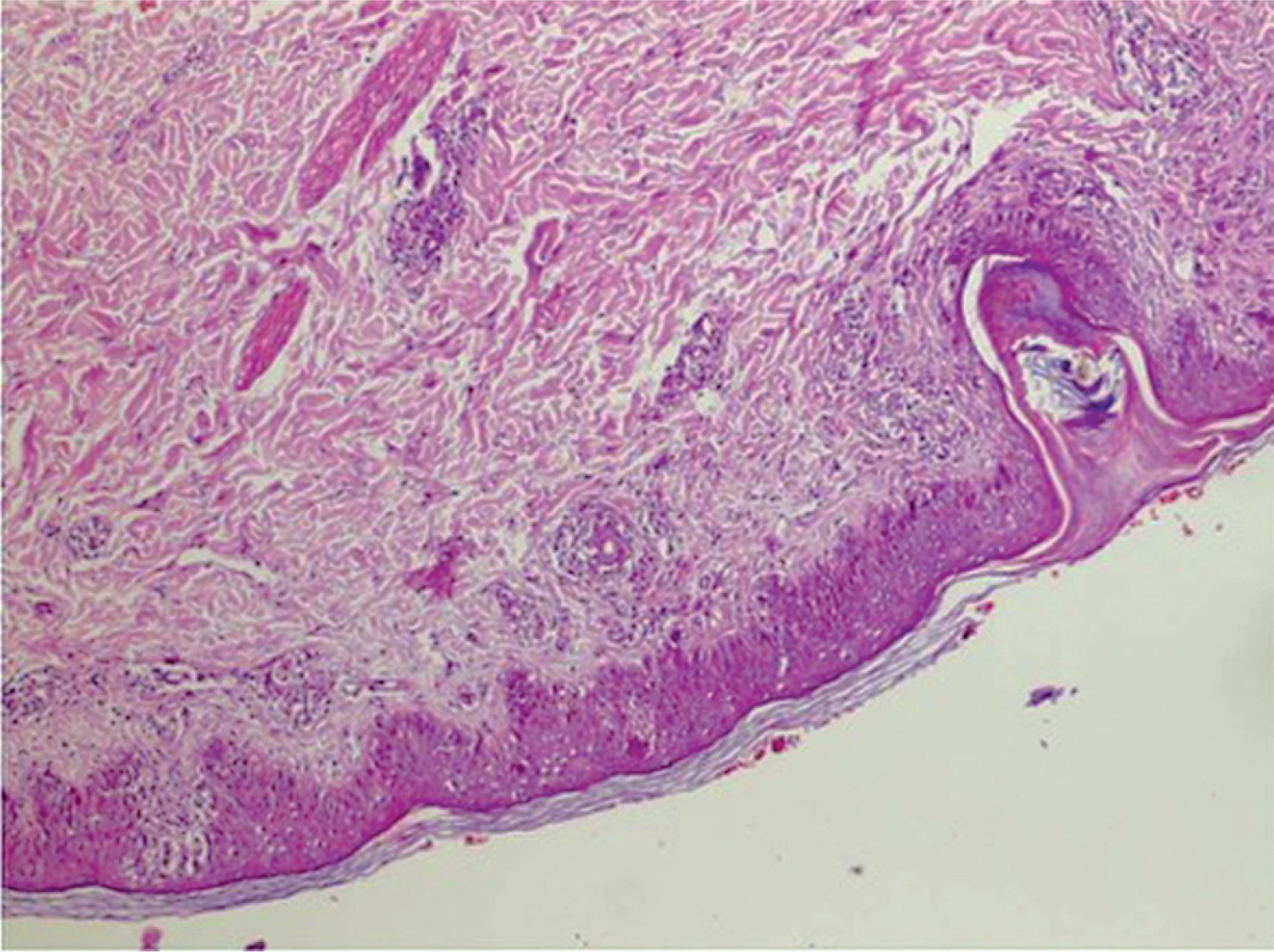 Carbamazepine-induced DRESS syndrome leading to reversible myocarditis ...