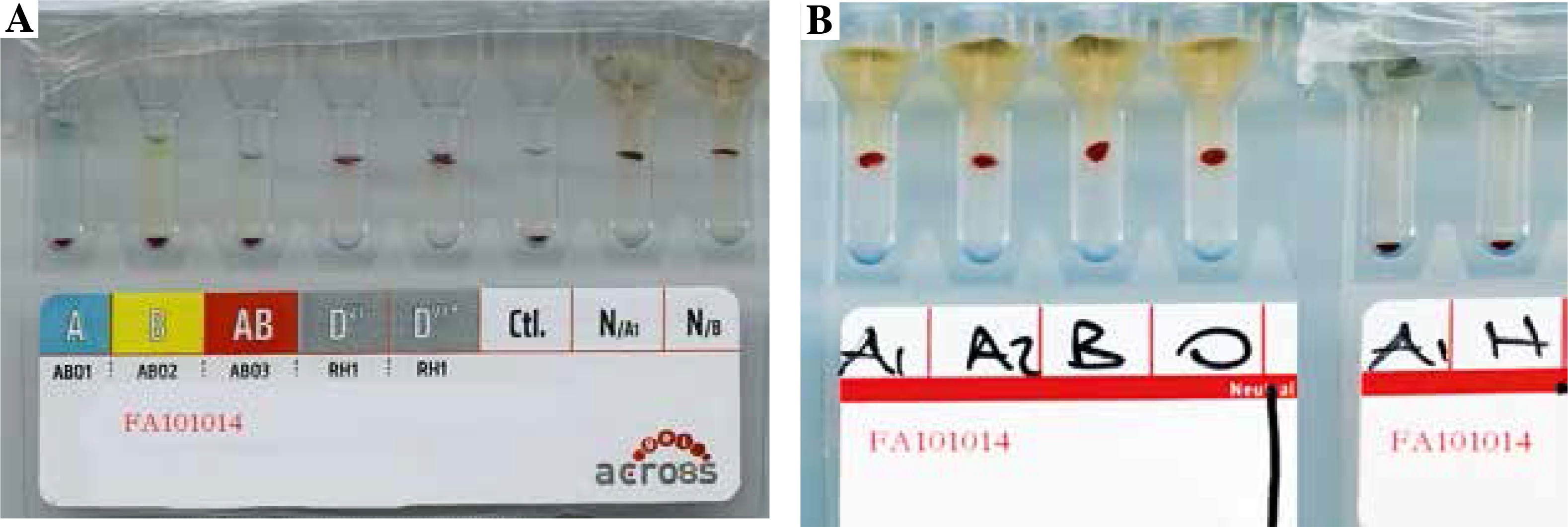 Late diagnosis of leukocyte adhesion deficiency type II and Bombay ...