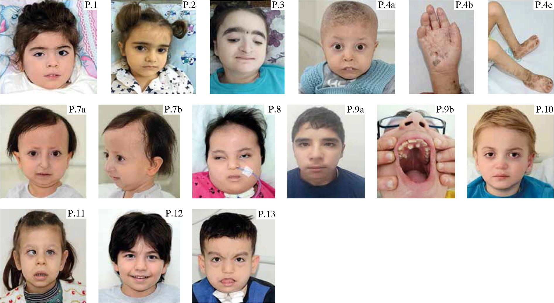 Evaluation of immunological abnormalities in patients with rare syndromes