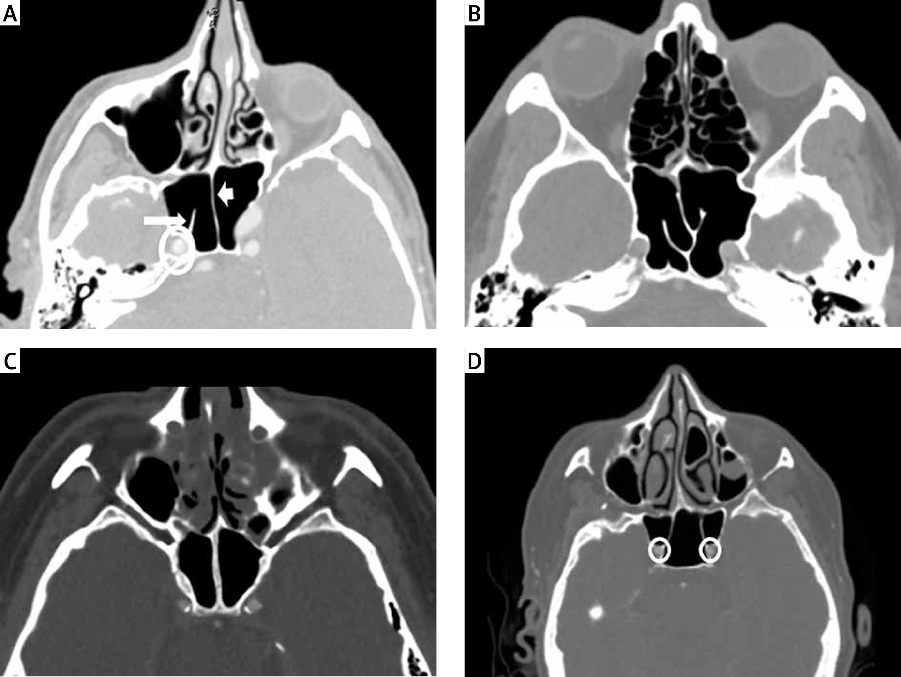 Sphenoid sinus septations and their interconnections with ...