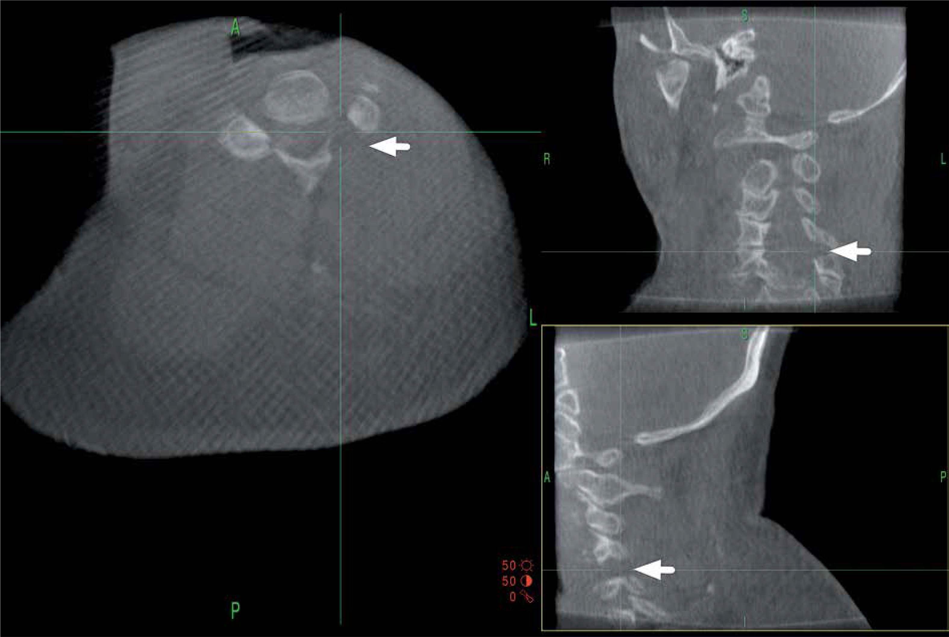Posterior percutaneous endoscopic cervical foraminotomy and discectomy ...