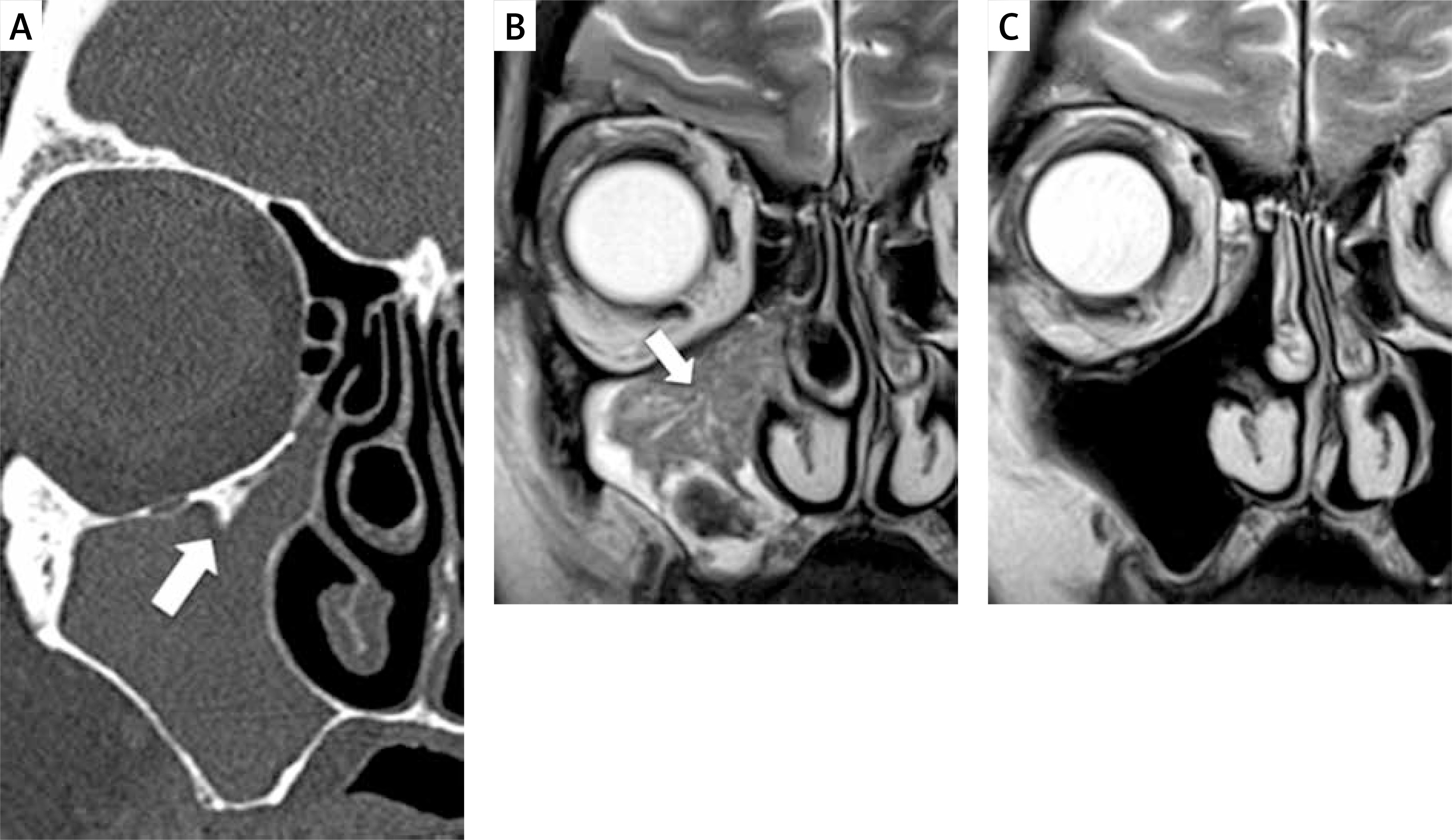 Endoscopic combined middle and inferior meatal antrostomies approach in ...