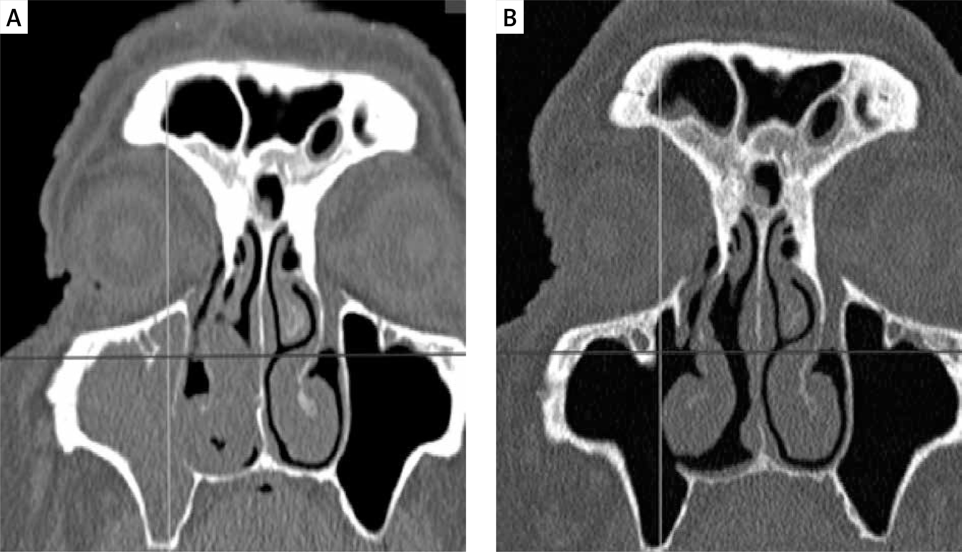Endoscopic combined middle and inferior meatal antrostomies approach in ...