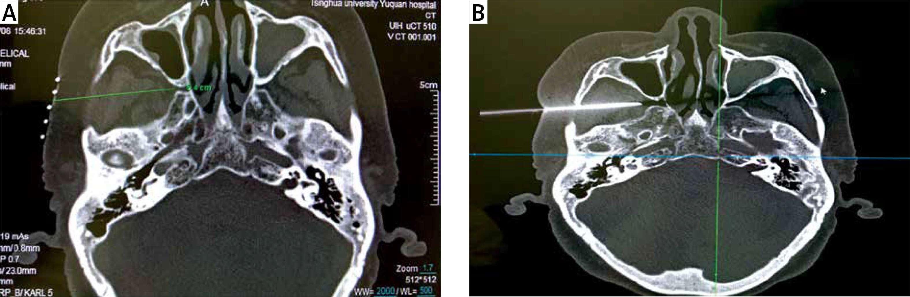 Sphenopalatine ganglion-targeted low-temperature plasma radiofrequency ...