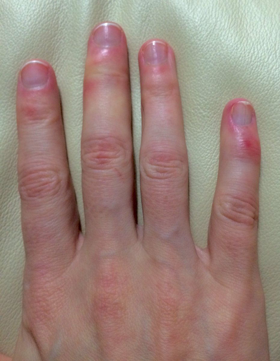 Objaw Raynauda w twardzinie układowej - Reumatologia – Termedia