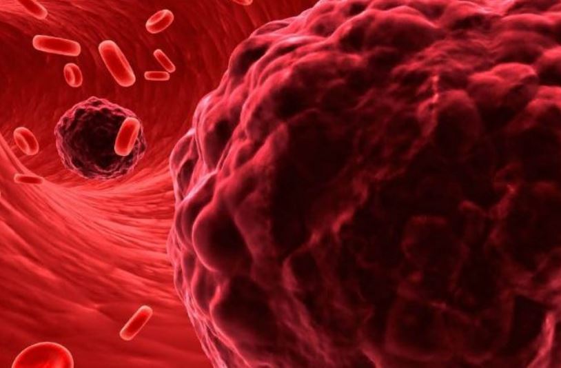 Nowotwory krwi coraz bardziej powszechne - Onkologia – Termedia