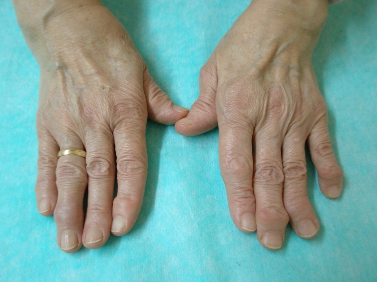 Aktualizacja zaleceń leczenia reumatoidalnego zapalenia stawów ...