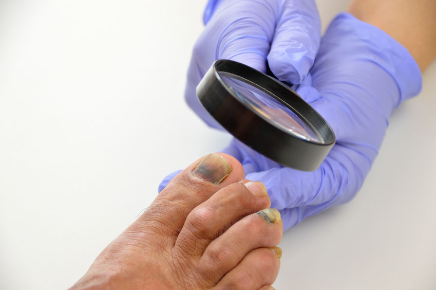 Czerniak paznokcia - rokowania - Dermatologia – Termedia