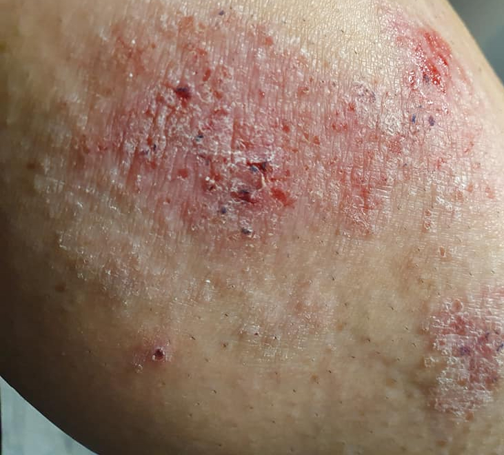 AZS to nie tylko choroba skóry - Dermatologia – Termedia