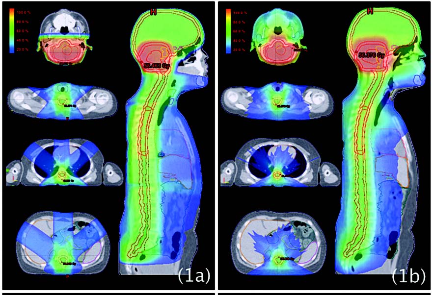 Tomotherapy – a different way of dose delivery in radiotherapy ...