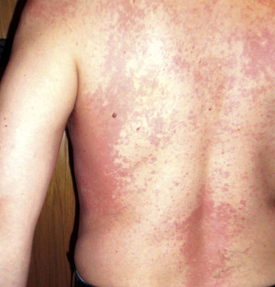 Non-itching urticaria-like lesions with transient myalgia in a father ...